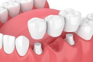 Best Dentist in Rajkot - Silver Smile Dental specialists